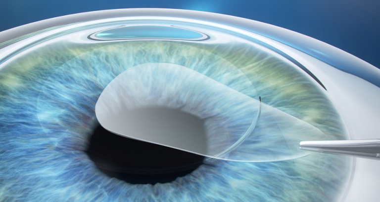 Centre Médico Chirurgical Paris - Oeil et Paupière